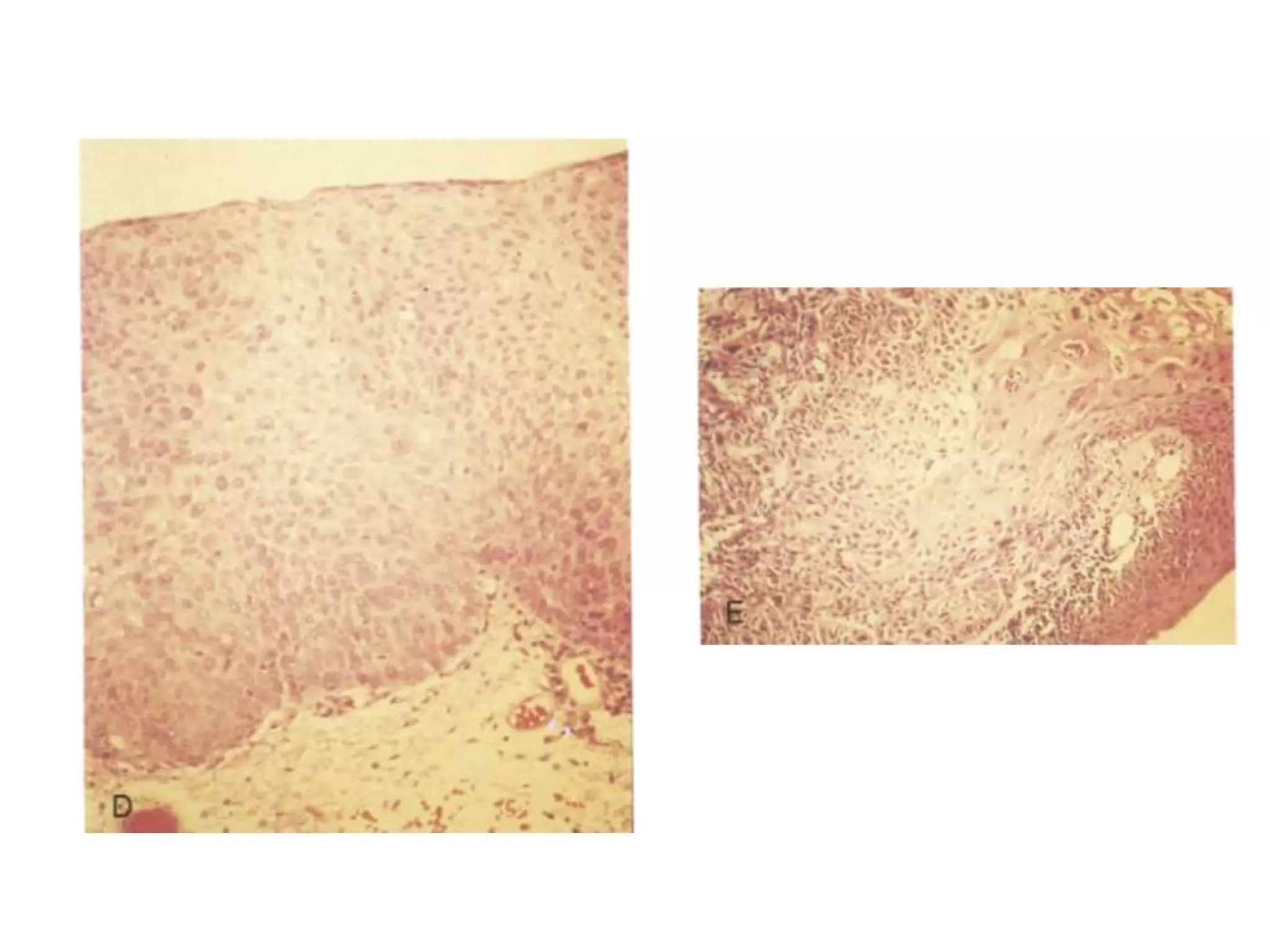 Ocular surface squamous neoplasia(ossn) | PPTX
