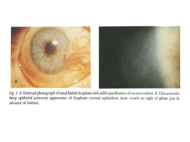 Ocular surface squamous neoplasia(ossn) | PPTX