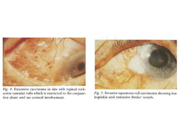 Ocular surface squamous neoplasia(ossn) | PPT