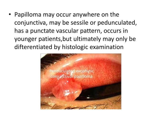 Ocular surface squamous neoplasia(ossn) | PPTX