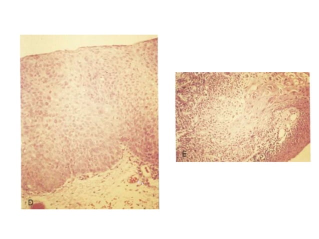 Ocular surface squamous neoplasia(ossn) | PPTX