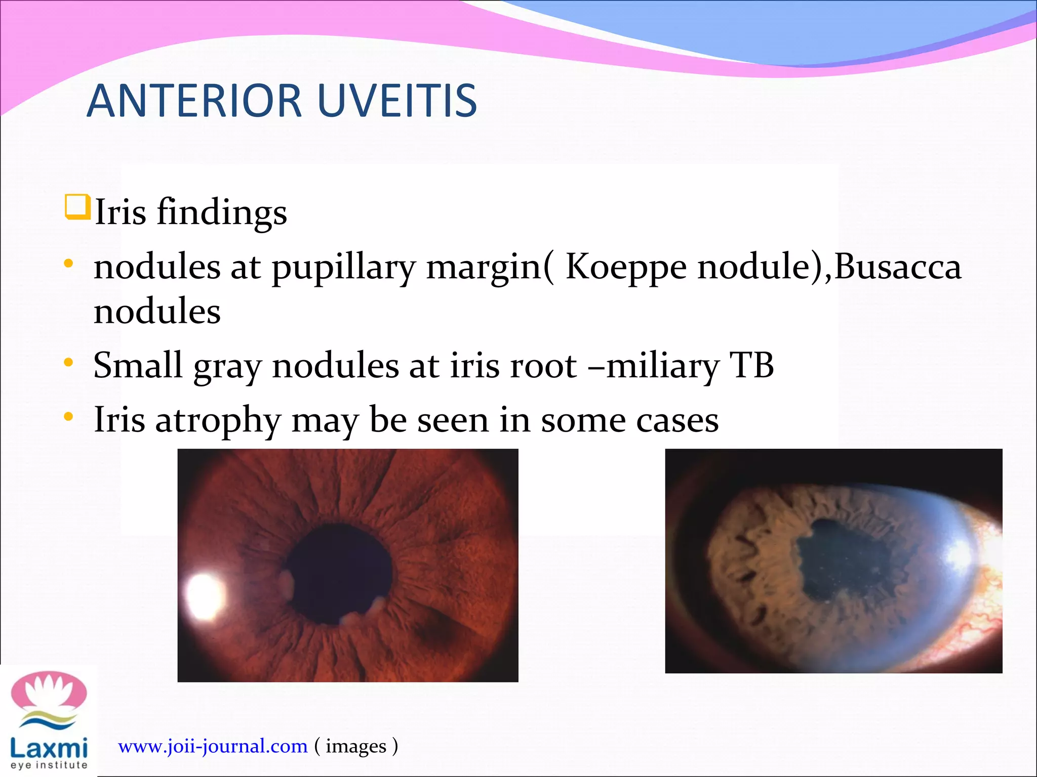 Ocular tb | PPT