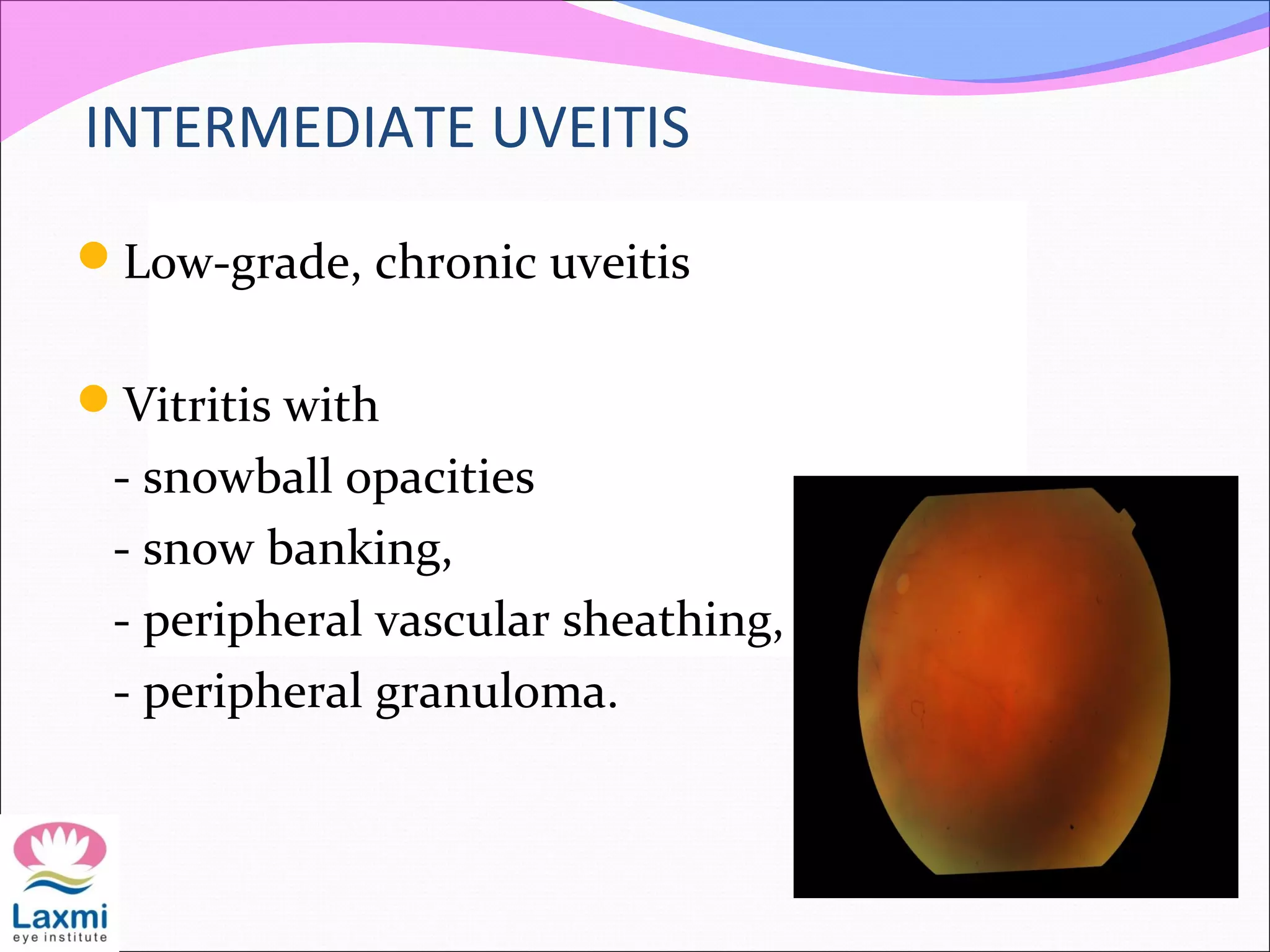 Ocular tb | PPT