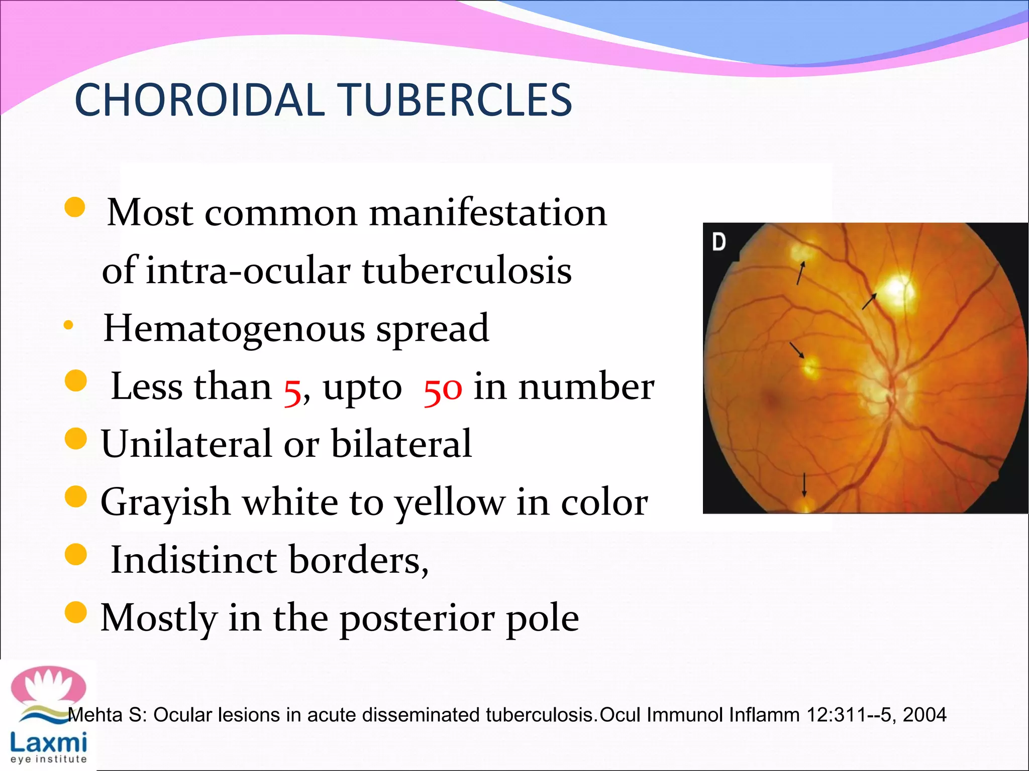 Ocular tb | PPT