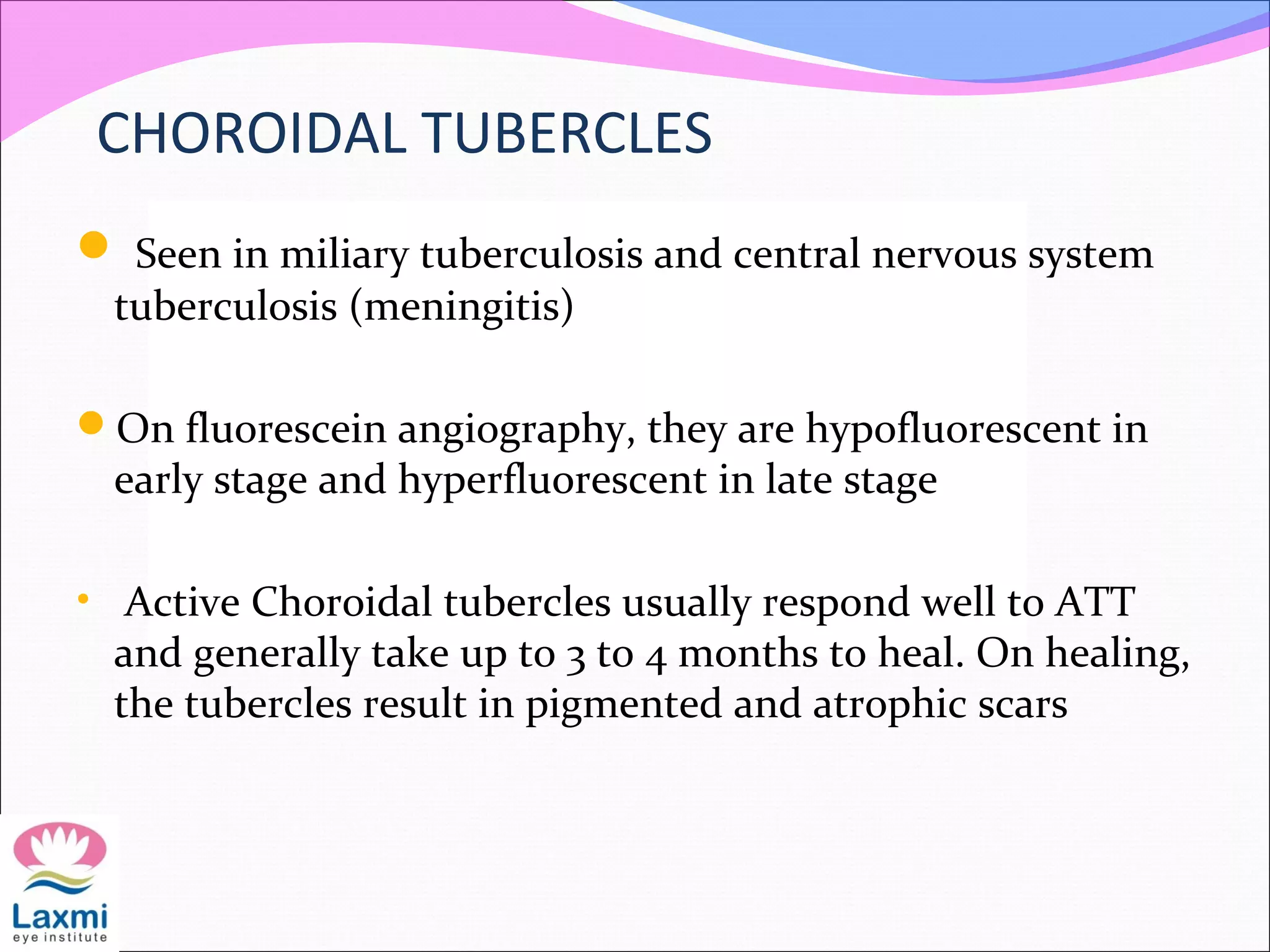 Ocular tb | PPT