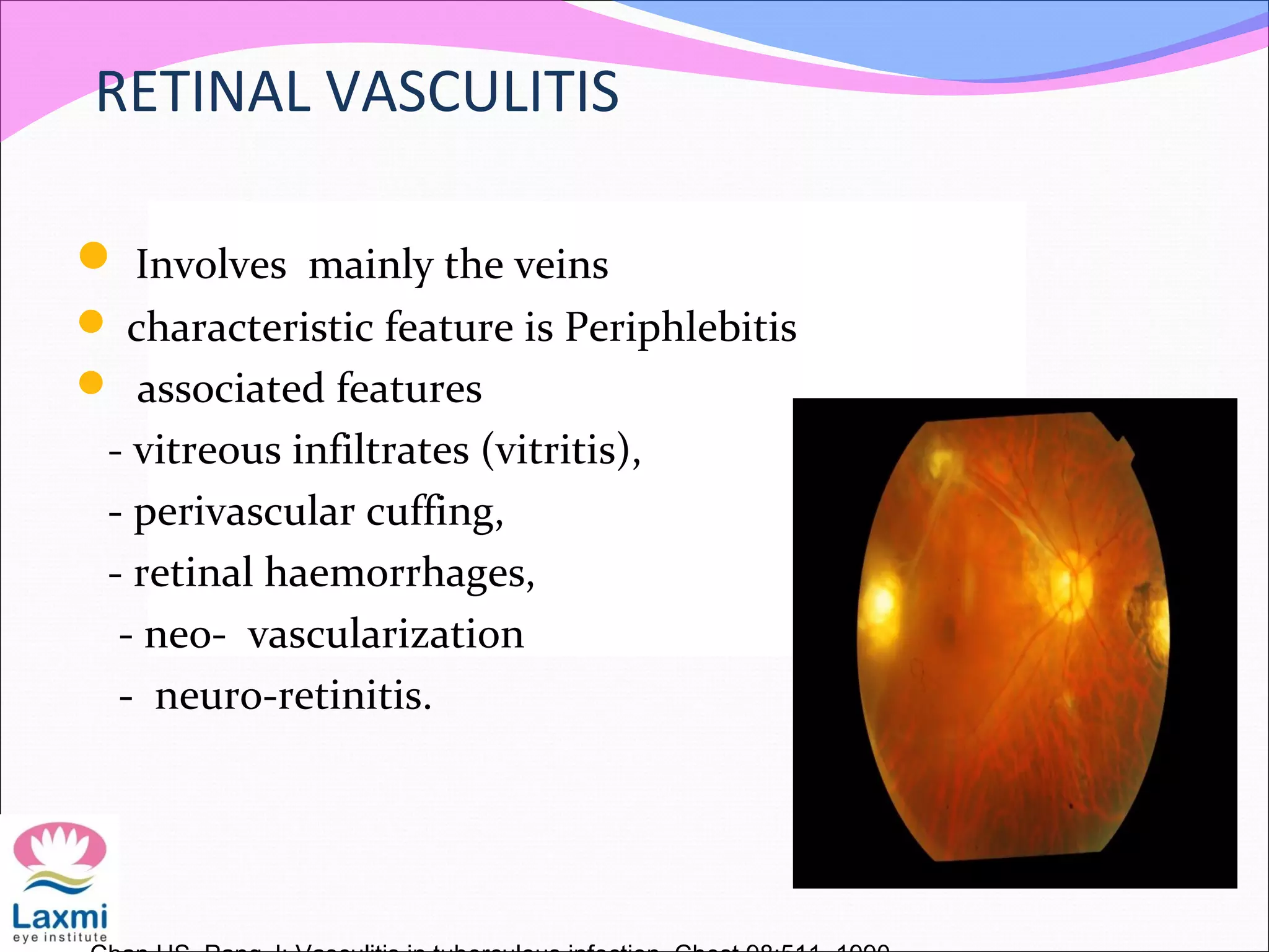 Ocular tb | PPT
