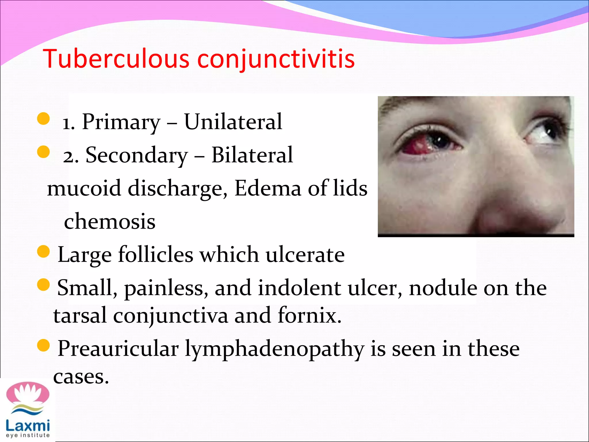 Ocular tb | PPT