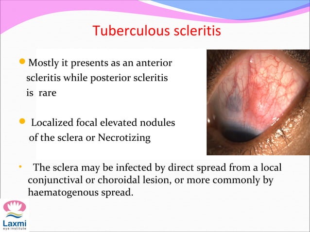 Ocular tb | PPT | Eye and Vision Conditions | Diseases and Conditions