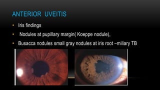 Ocular tb | PPTX