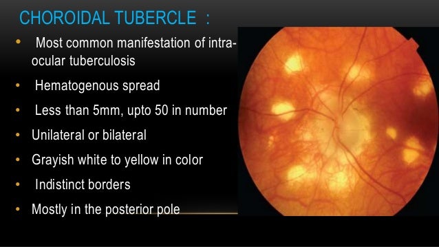 Ocular tb