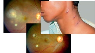 Ocular tb | PPTX
