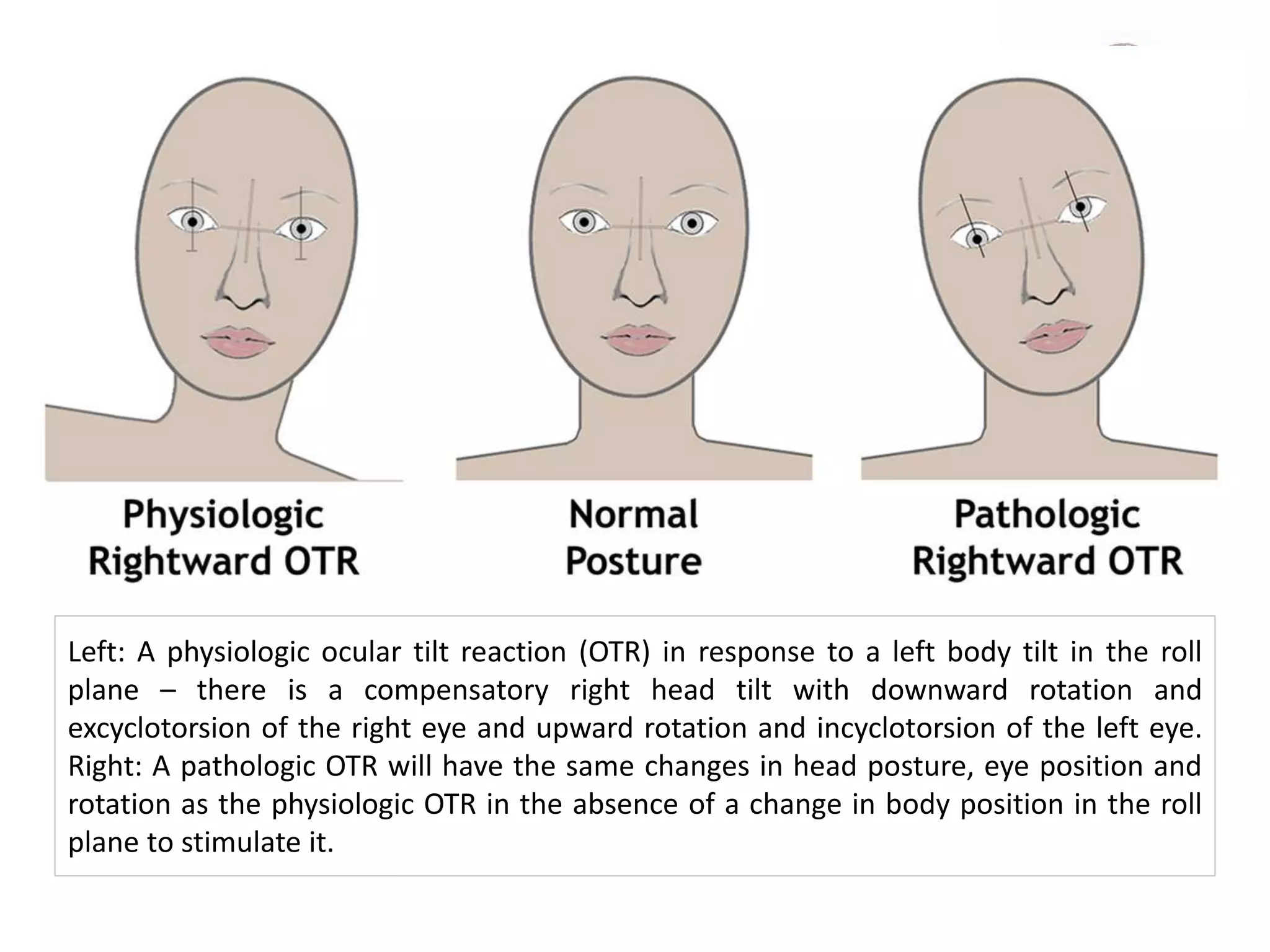 Ocular tilt reaction and skew deviation | PPTX