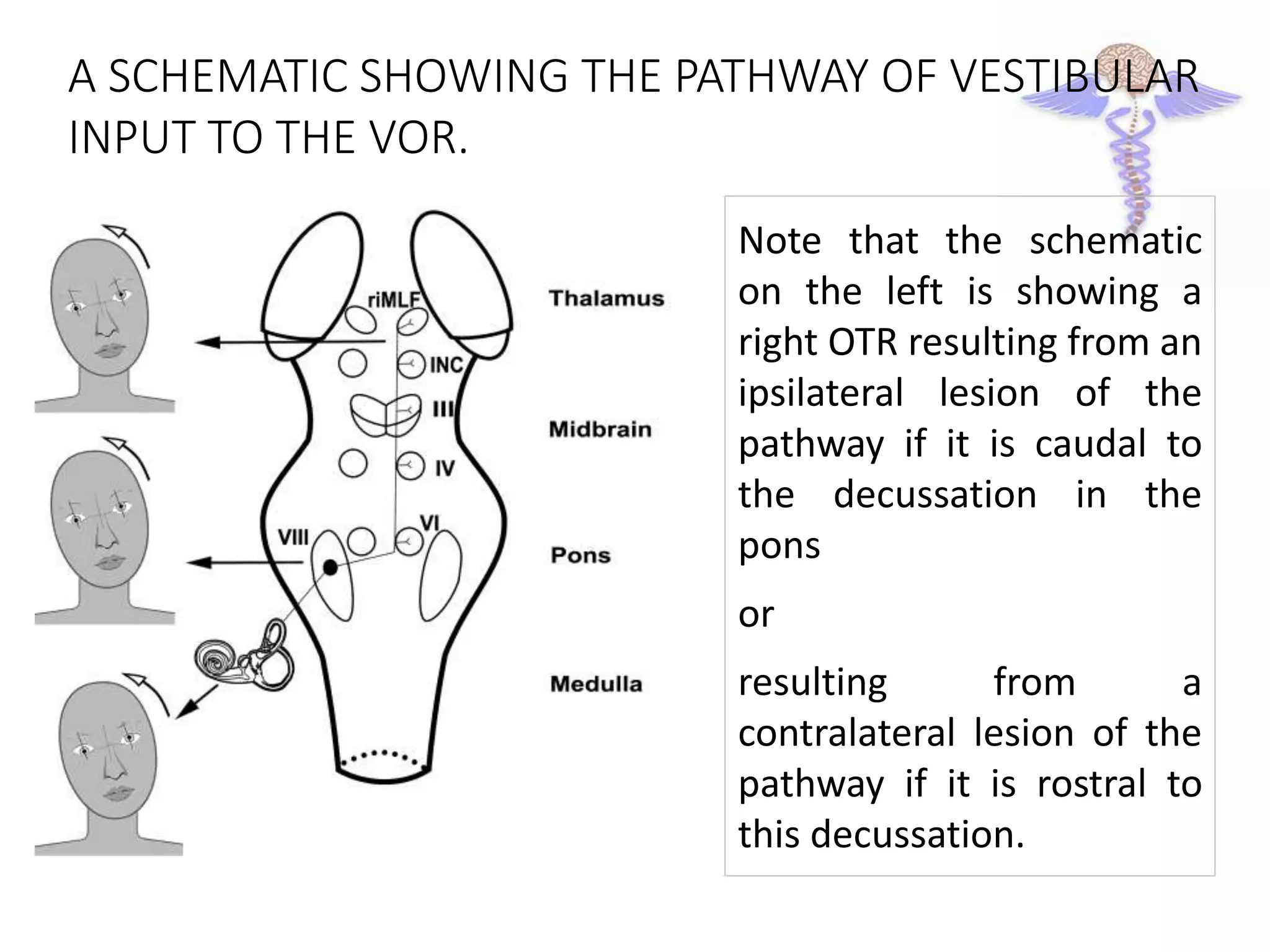 Ocular tilt reaction and skew deviation | PPTX