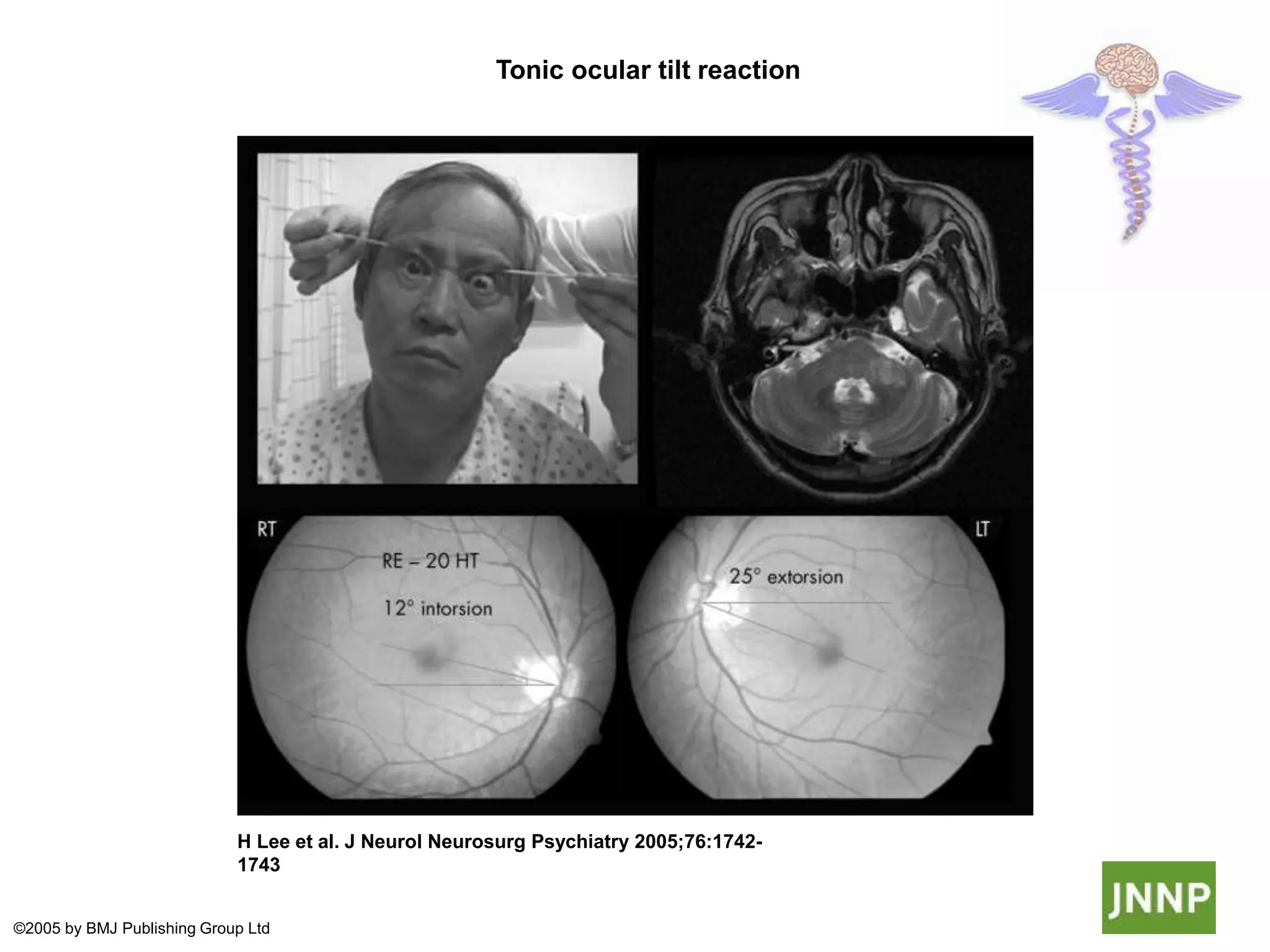 Ocular tilt reaction and skew deviation | PPTX