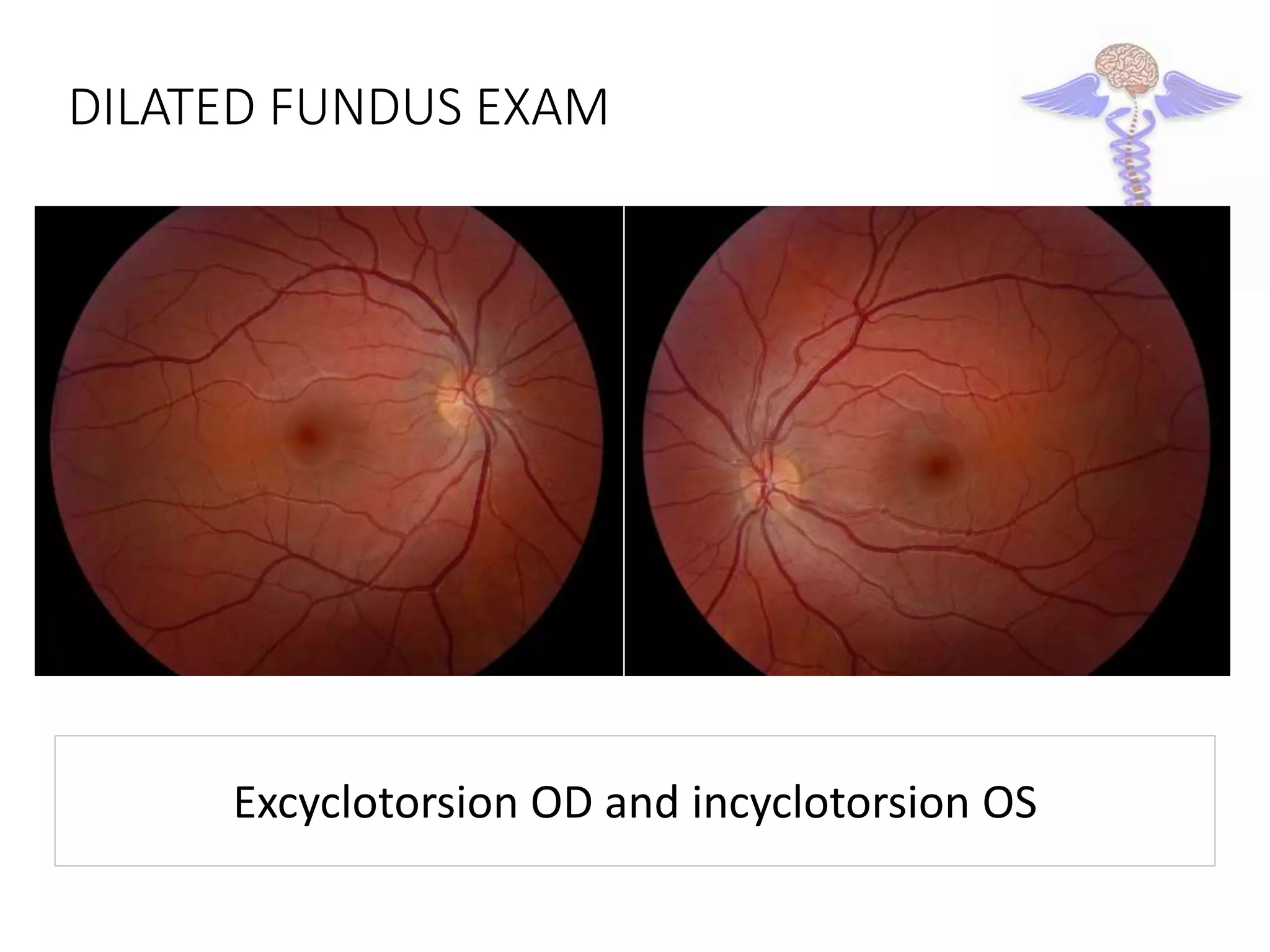 Ocular tilt reaction and skew deviation | PPTX