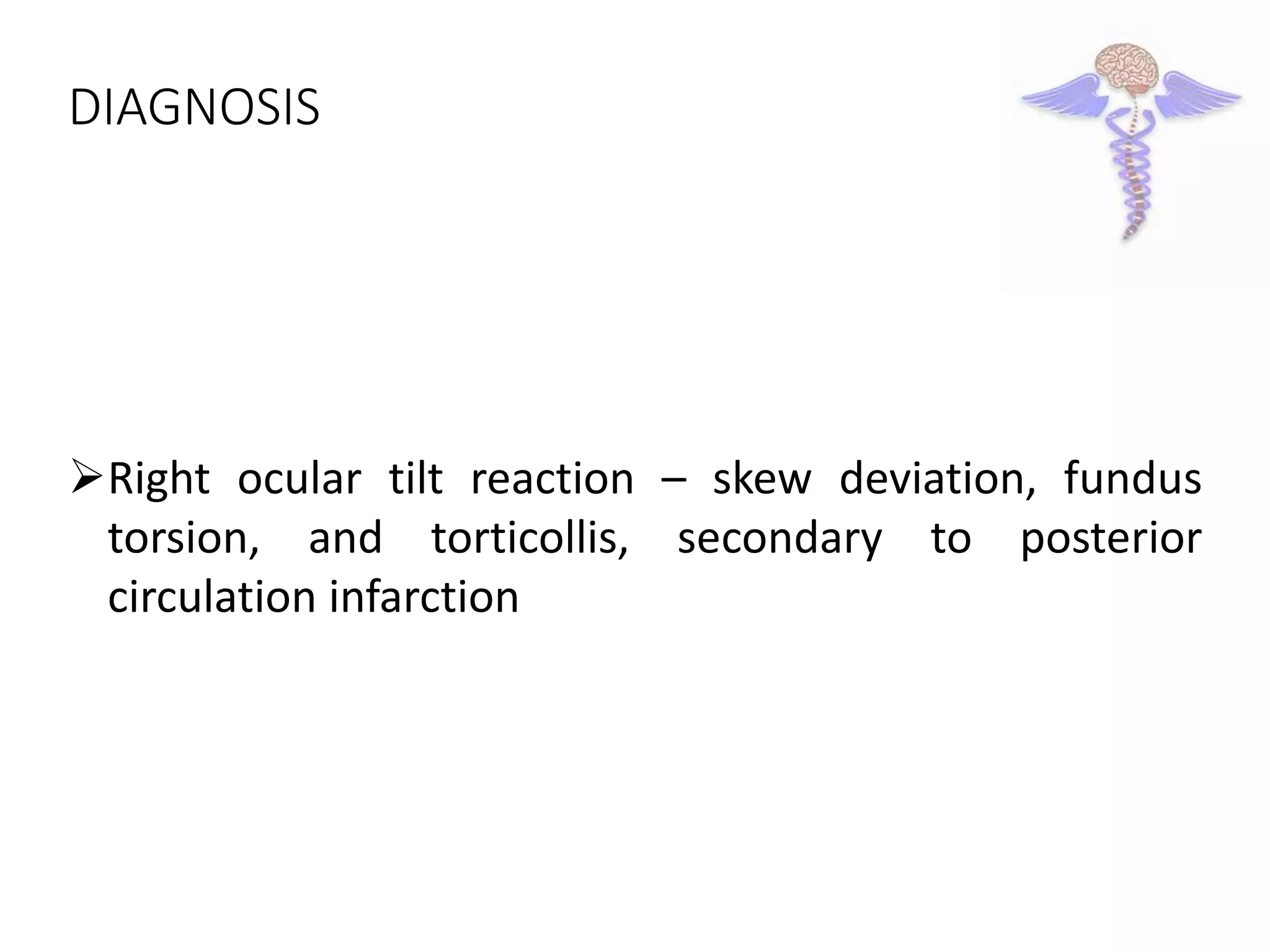 Ocular tilt reaction and skew deviation | PPTX
