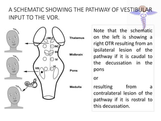 Ocular tilt reaction and skew deviation | PPTX