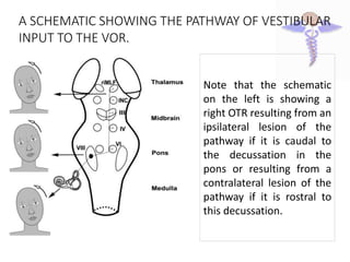 Ocular tilt reaction and skew deviation | PPTX