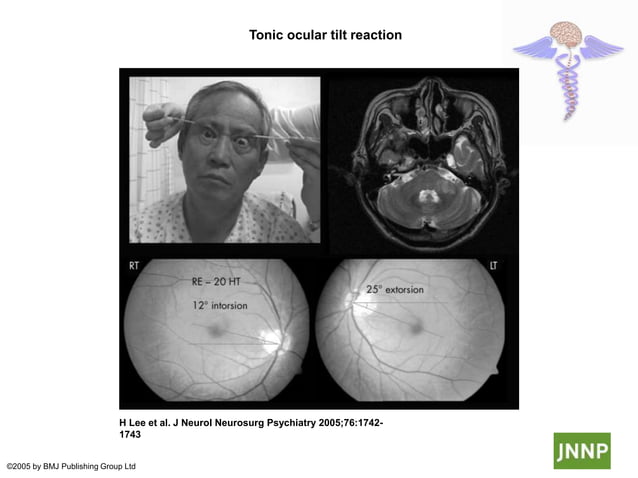Ocular tilt reaction and skew deviation | PPTX