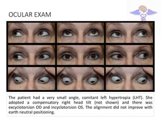 Ocular tilt reaction and skew deviation | PPTX