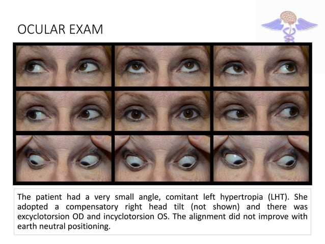 Ocular tilt reaction and skew deviation | PPTX
