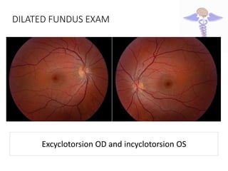 Ocular tilt reaction and skew deviation | PPTX