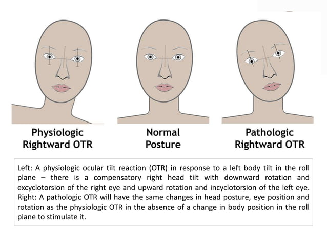 Ocular tilt reaction and skew deviation