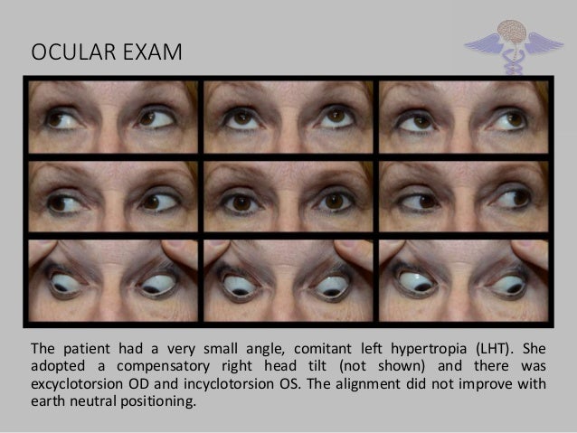 Ocular tilt reaction and skew deviation