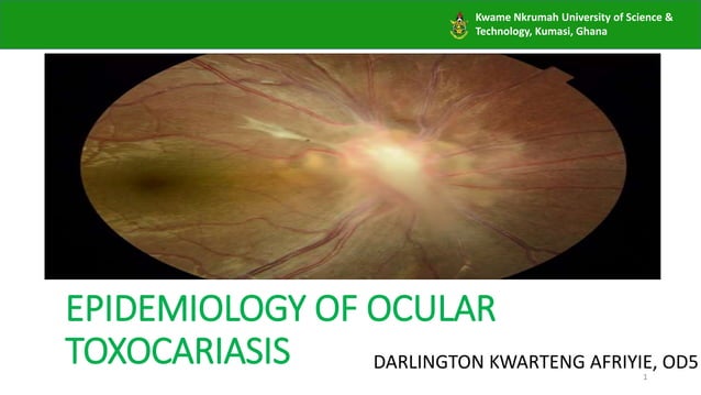 Ocular toxocariasis | PPTX