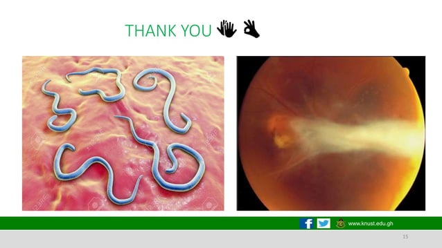 Ocular toxocariasis | PPTX