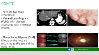Ocular toxocariasis | PPTX
