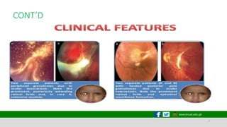 Ocular toxocariasis | PPTX