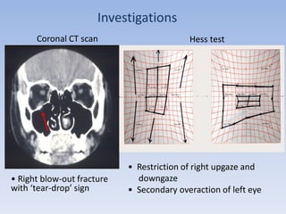 oculartrauma-140917145547-phpapp01.pdf