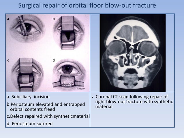 Ocular trauma | PDF
