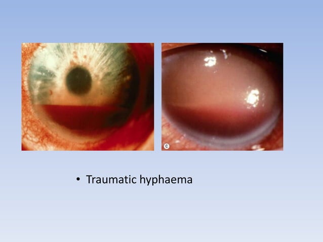 Ocular trauma | PDF