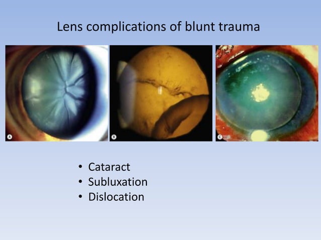 Ocular trauma | PDF