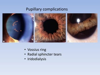 Ocular trauma | PPT