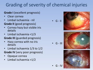 Ocular trauma | PPT