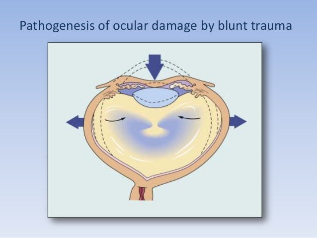 Ocular trauma