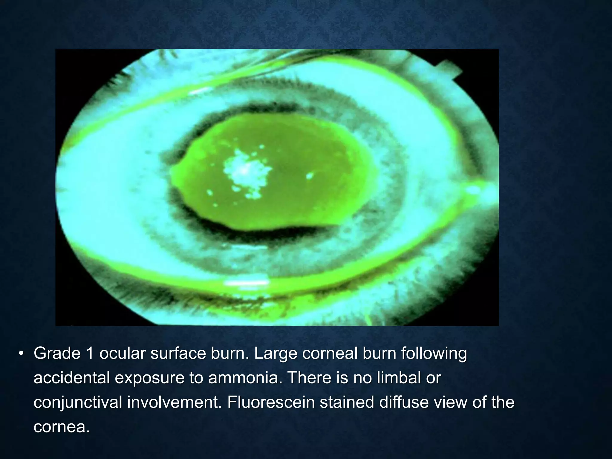 Ocular trauma | PPTX