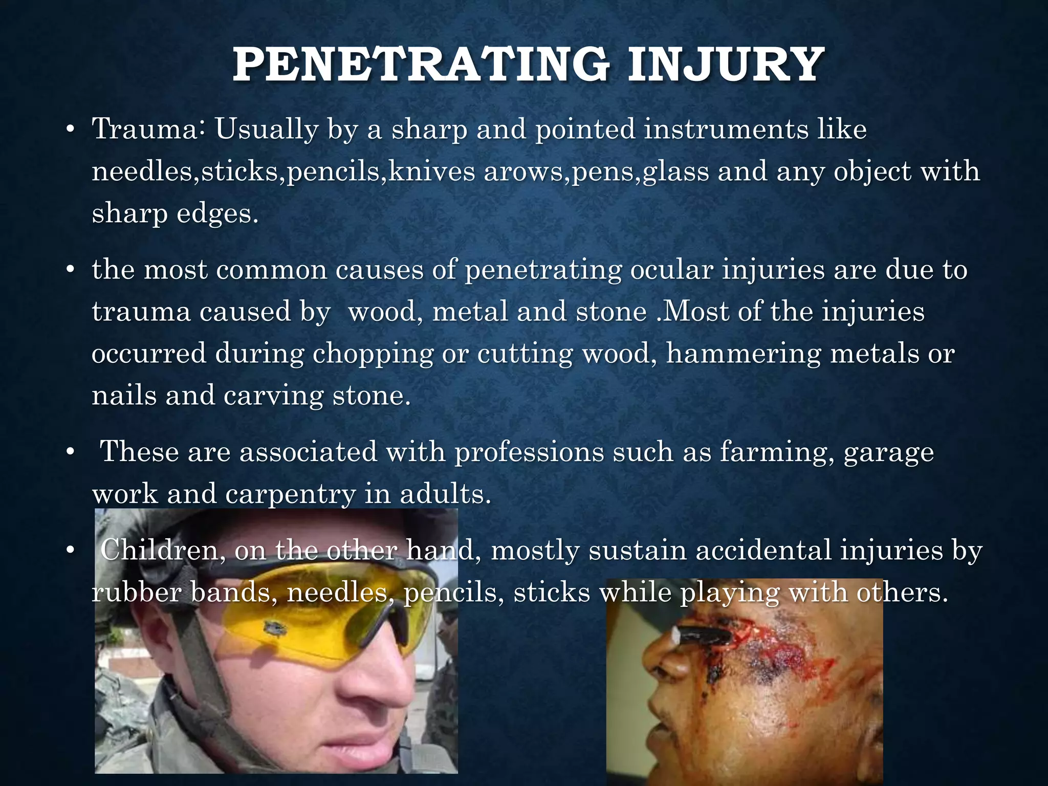 Ocular trauma | PPTX