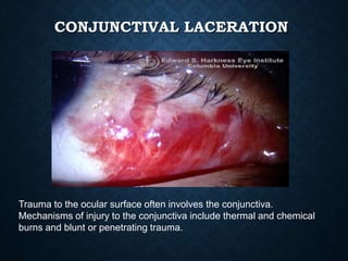 Ocular trauma | PPTX