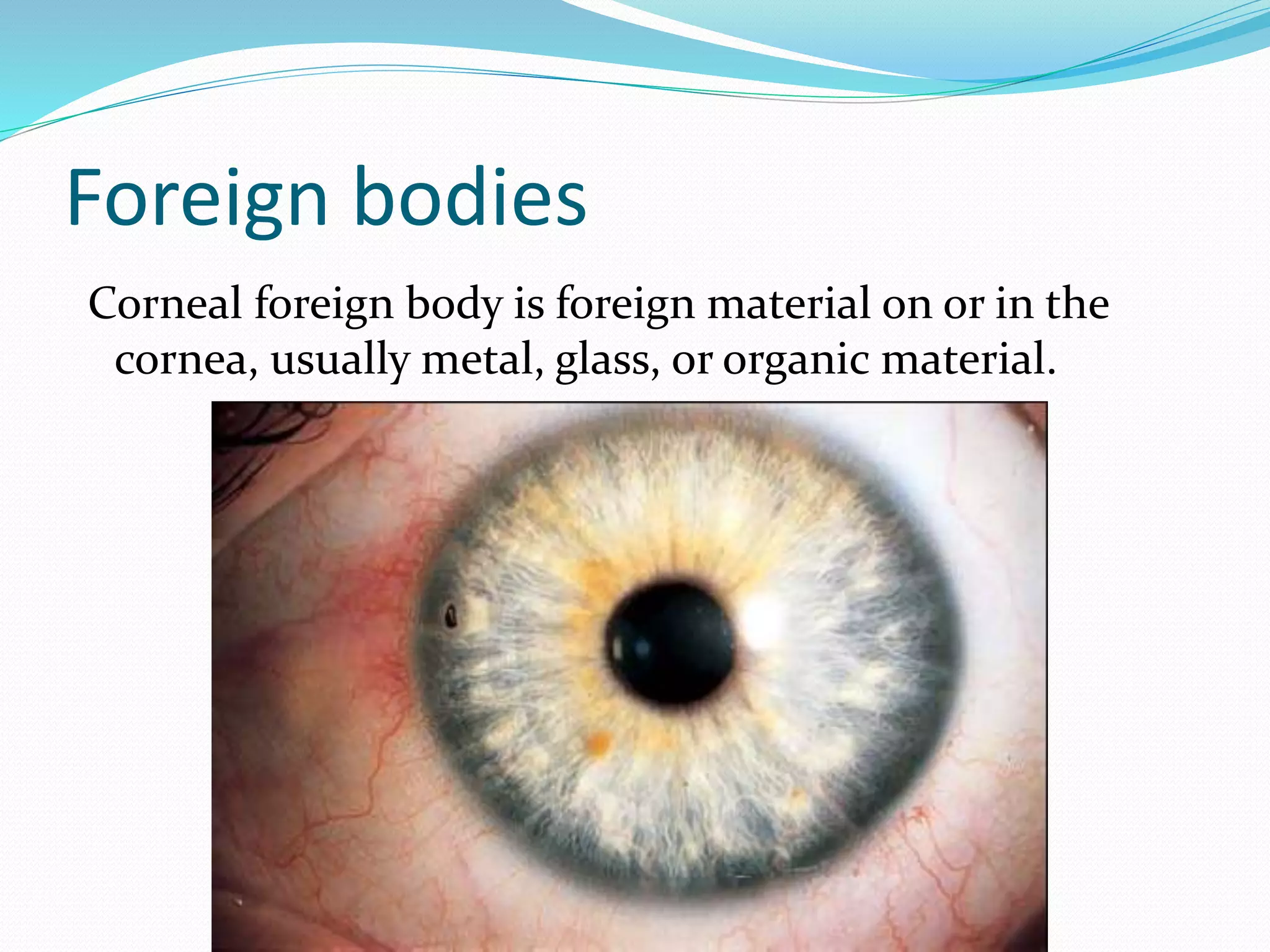 Ocular trauma | PPTX