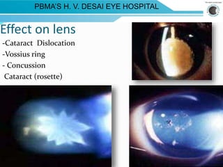 Ocular trauma | PPTX
