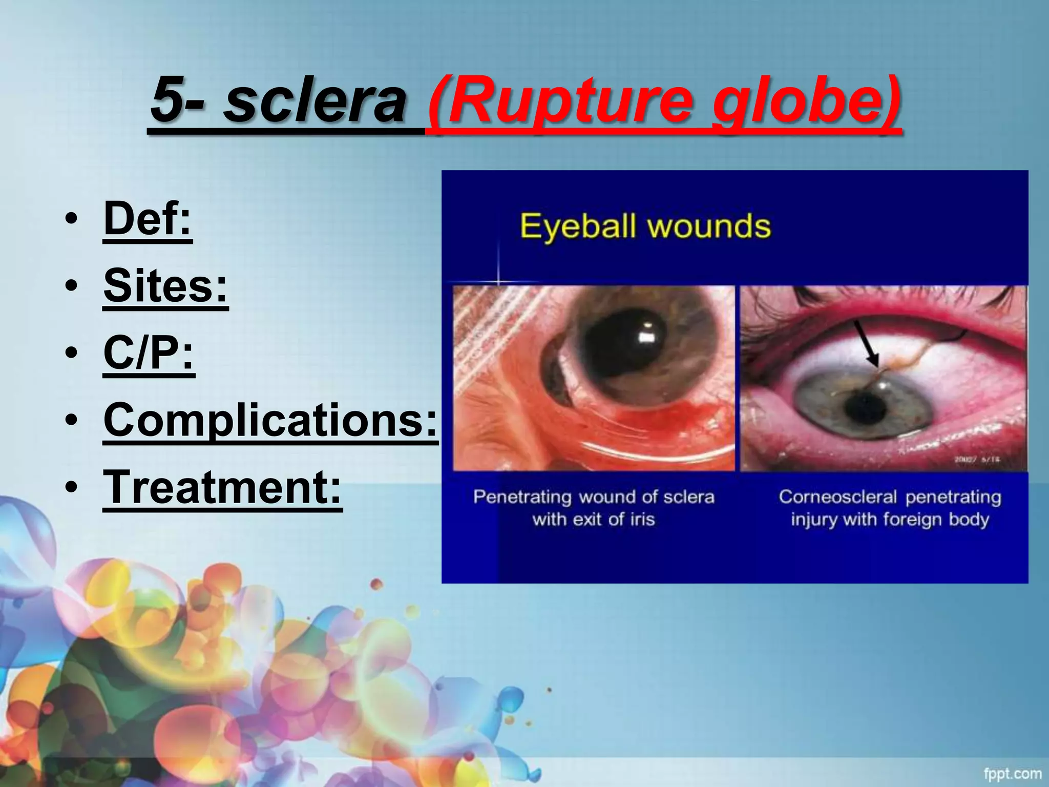Ocular trauma | PPT