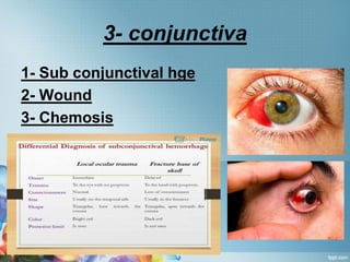 Ocular trauma | PPT
