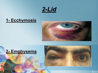 Ocular trauma | PPT