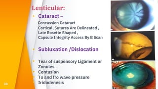 Ocular Trauma | PPTX