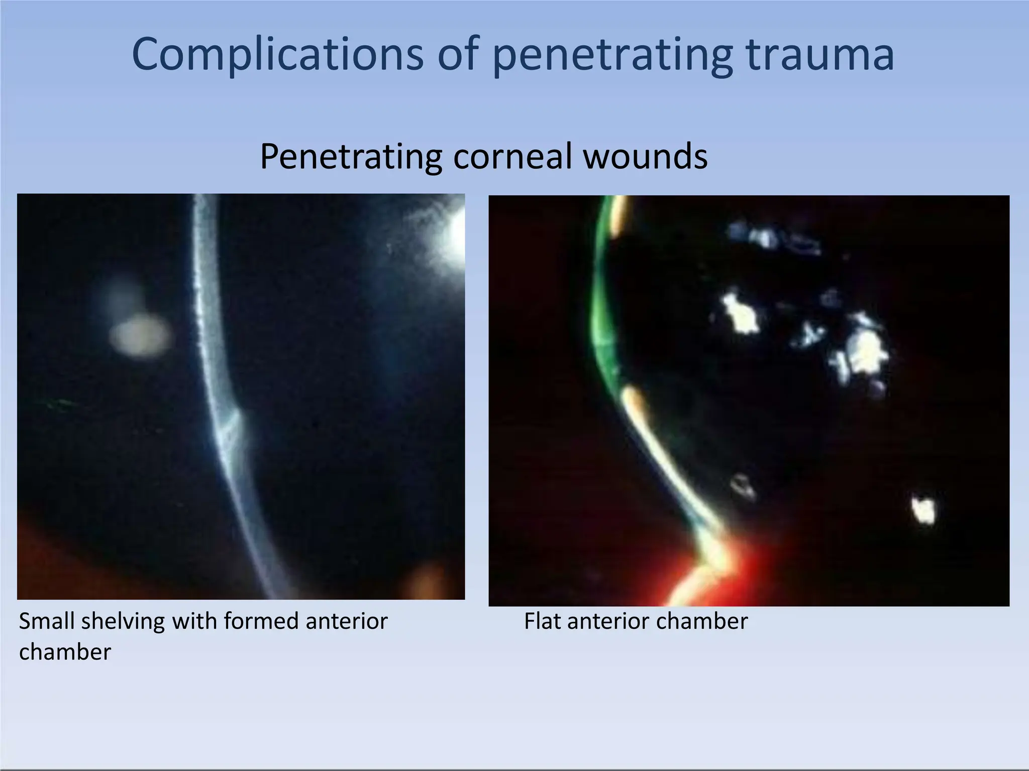 Ocular Trauma , mentioning soft tissue and bony trauma | PPT