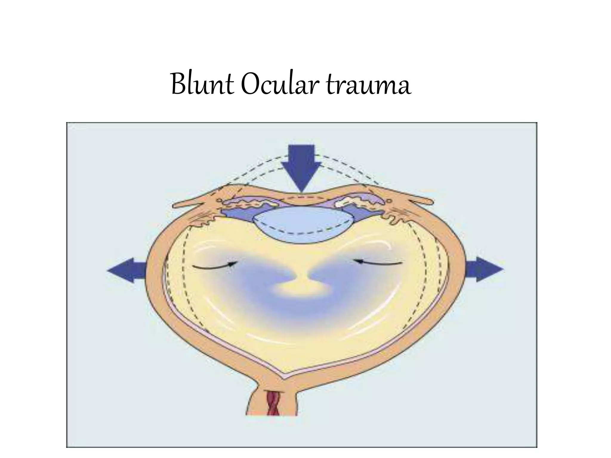 Blunt Ocular trauma | PPTX
